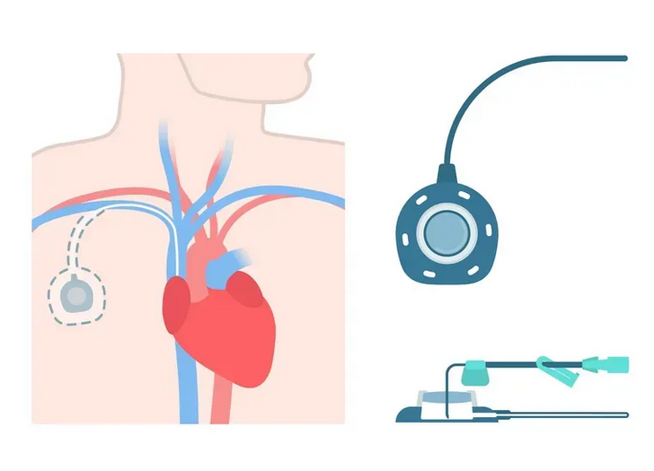 پورت چیست؟ | بیمارستان مرتاض یزد